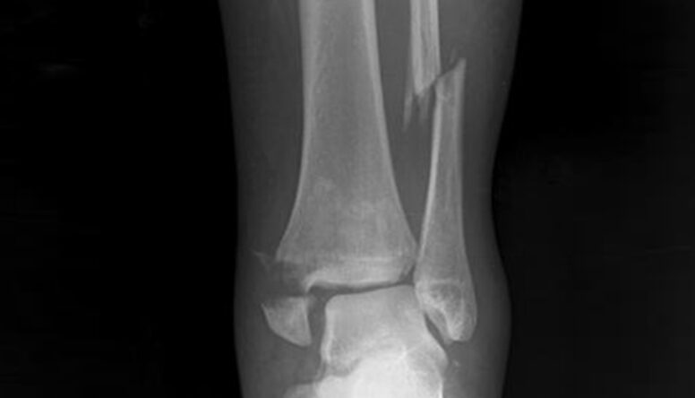 Fracture Symptoms & Diagnosis | The New Foscote Hospital