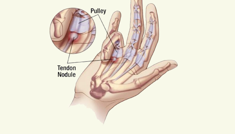 Trigger Finger Treatment in Banbury | Foscote Hospital